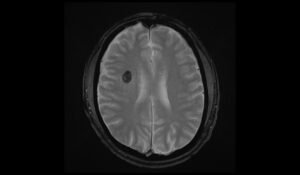 Cavernoma MRI | Radiology Article on Cavernous Hemangioma