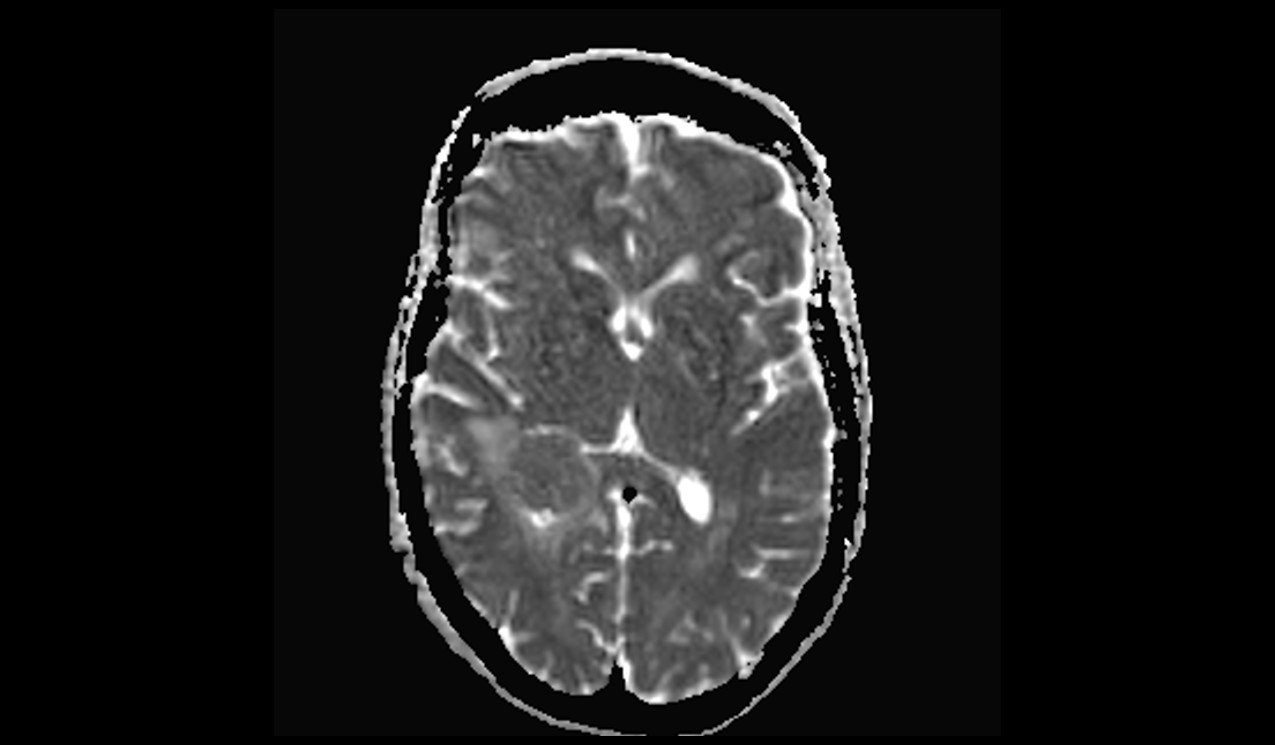 Choroid Plexus Papilloma (CPP) MRI | Radiology Article on Choroid ...