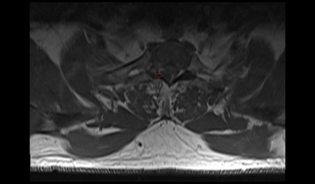 Spinal epidural hematoma MRI | Radiology article on Spinal epidural ...