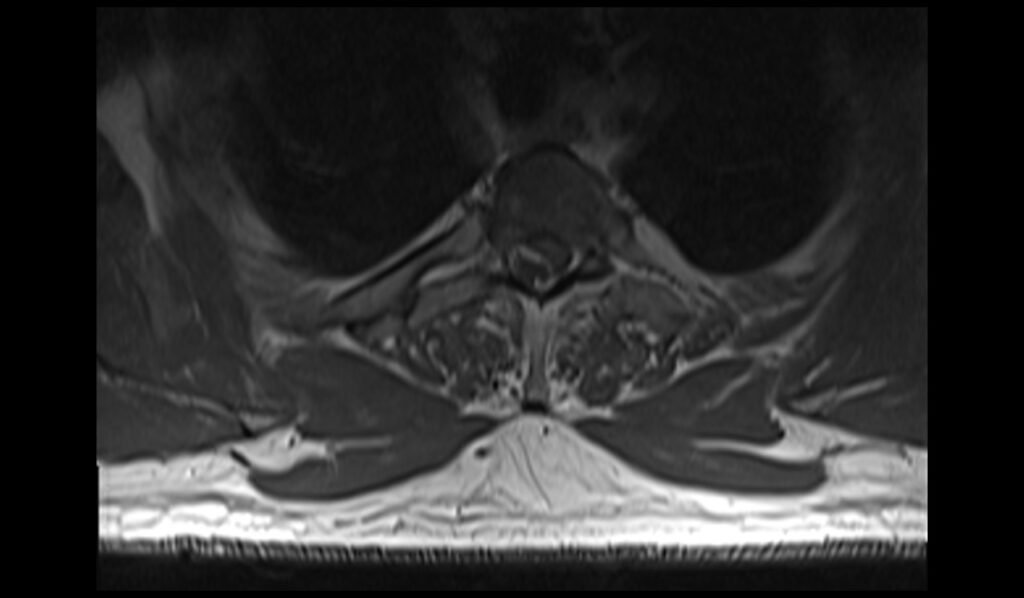Spinal epidural hematoma MRI | Radiology article on Spinal epidural ...