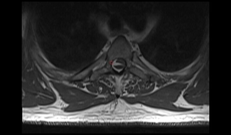 Spinal epidural hematoma MRI | Radiology article on Spinal epidural ...