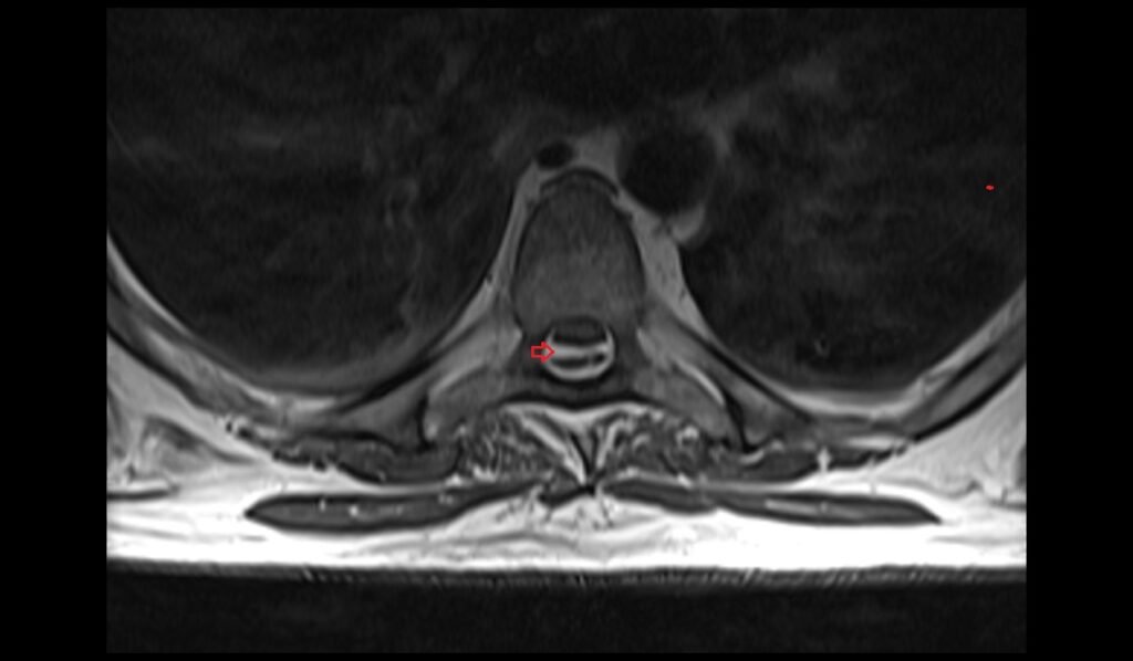 Spinal epidural hematoma MRI | Radiology article on Spinal epidural ...