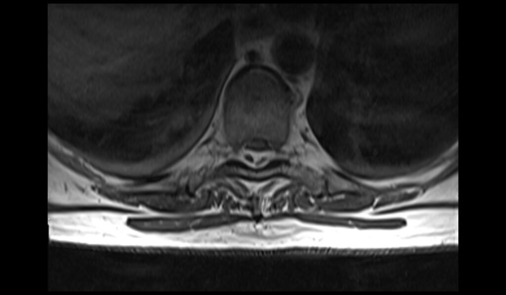 Spinal epidural hematoma MRI | Radiology article on Spinal epidural ...