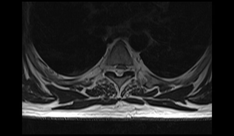 Spinal epidural hematoma MRI | Radiology article on Spinal epidural ...