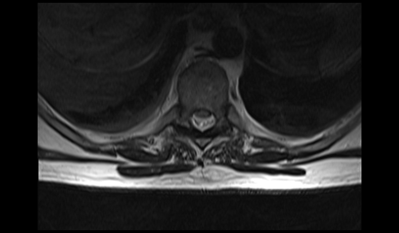 Spinal epidural hematoma MRI | Radiology article on Spinal epidural ...