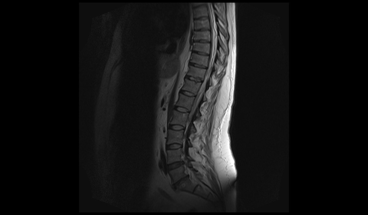 Spinal epidural hematoma MRI | Radiology article on Spinal epidural ...