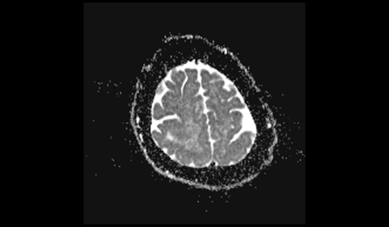 Pachygyria MRI | Radiology Article on Oligodendroglioma