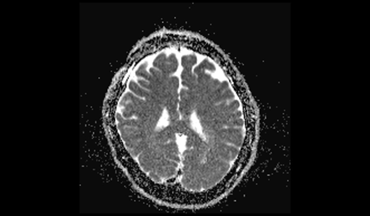 Sturge-Weber syndrome MRI | Radiology Article on Sturge-Weber syndrome