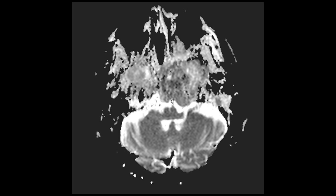 Clival Chordoma MRI | Radiology Article on Clival Chordoma