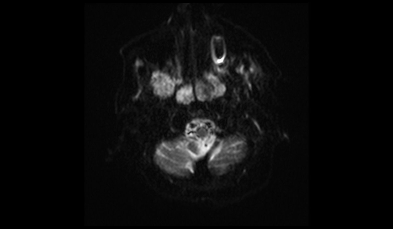 Clival Chordoma MRI | Radiology Article on Clival Chordoma