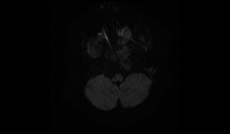 Clival Chordoma MRI | Radiology Article on Clival Chordoma