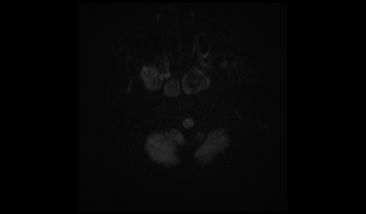 Clival Chordoma MRI | Radiology Article on Clival Chordoma