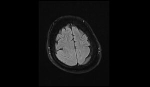 Pachygyria MRI | Radiology Article on Oligodendroglioma