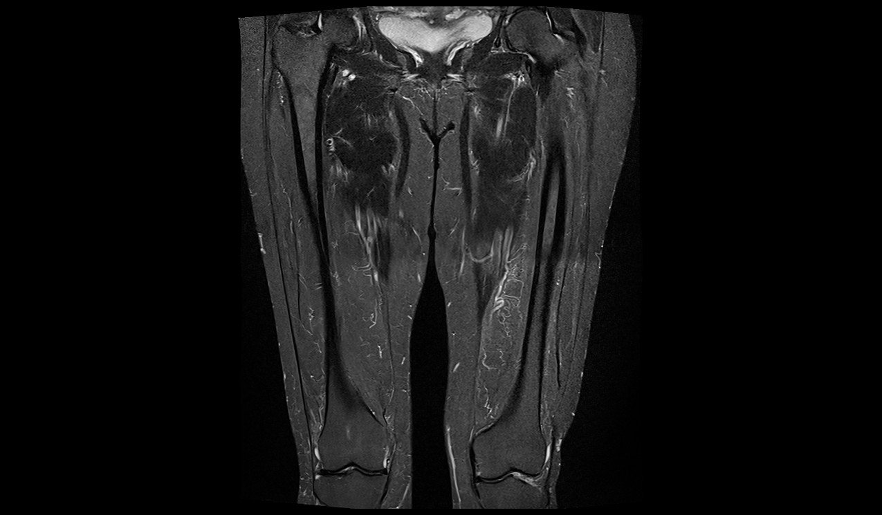 Collagen VI-Related Myopathies MRI | Radiology article on Collagen VI ...