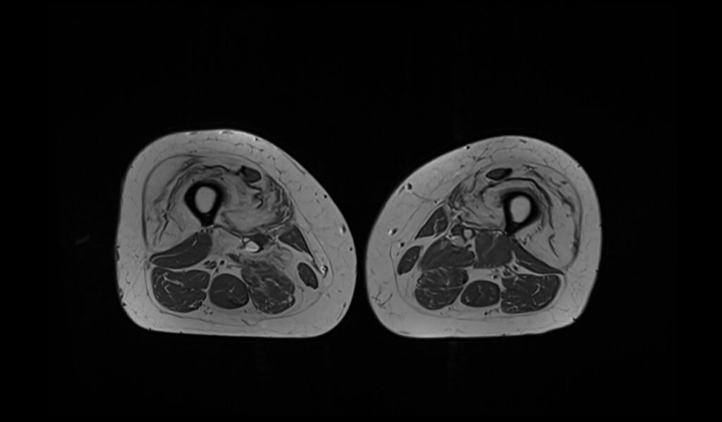 Collagen VI-Related Myopathies MRI | Radiology article on Collagen VI ...