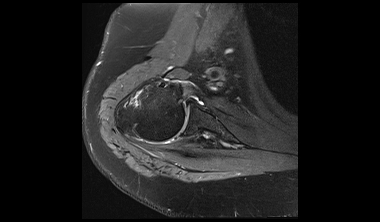 Greater Tuberosity Avulsion Fracture MRI | Radiology Article on Greater ...