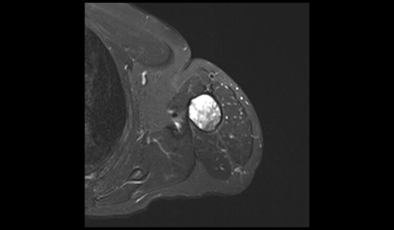 Polyostotic fibrous dysplasia MRI | Radiology Article on Polyostotic ...