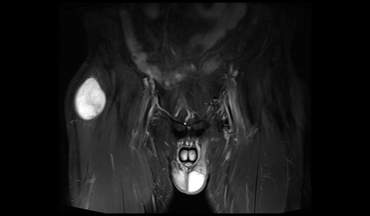 Soft tissue sarcoma MRI | Radiology article on Soft tissue sarcoma MRI