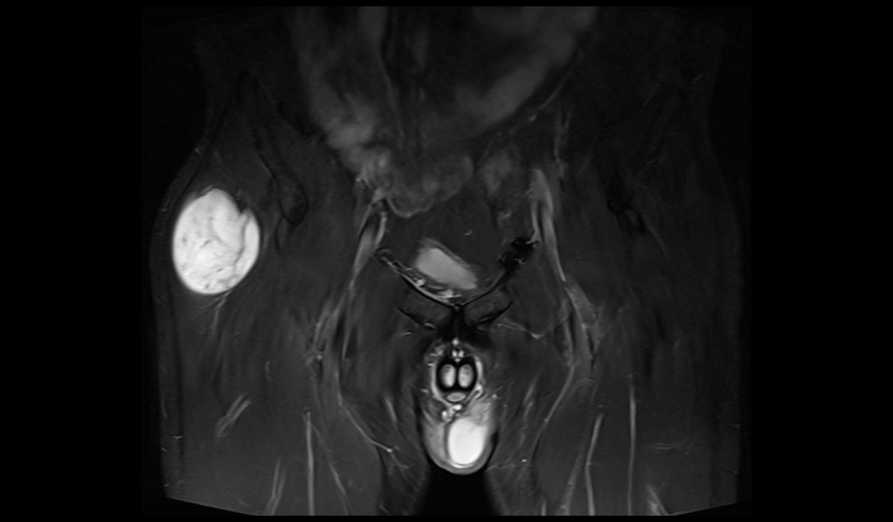 Soft tissue sarcoma MRI | Radiology article on Soft tissue sarcoma MRI