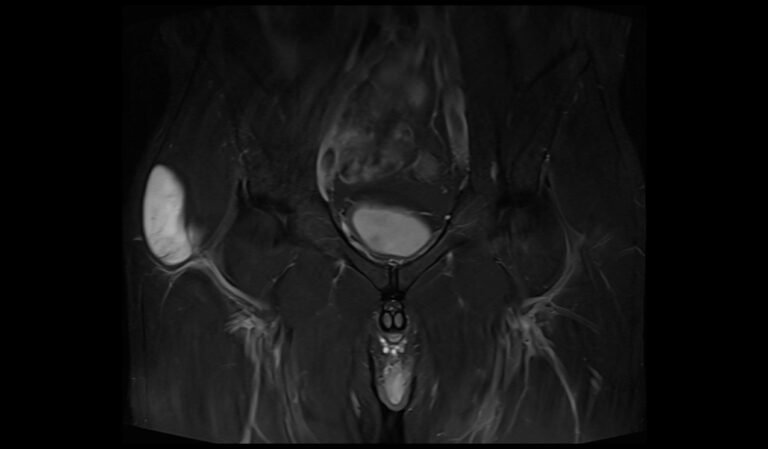 Soft tissue sarcoma MRI | Radiology article on Soft tissue sarcoma MRI