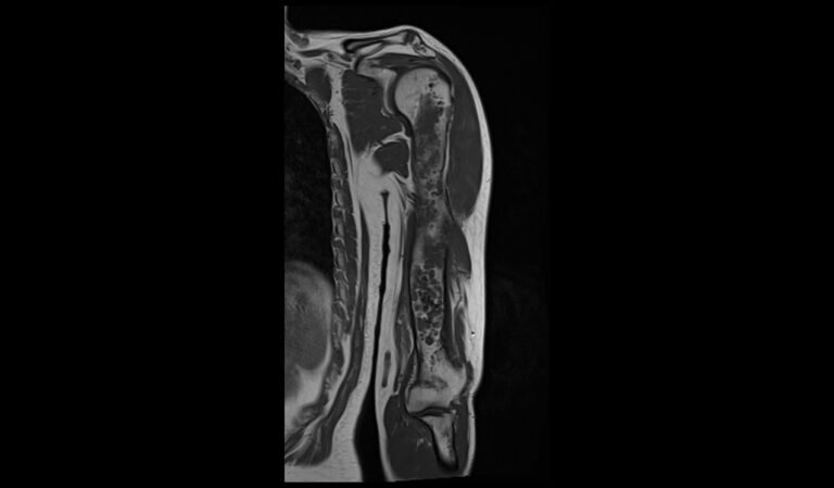 Polyostotic fibrous dysplasia MRI | Radiology Article on Polyostotic ...