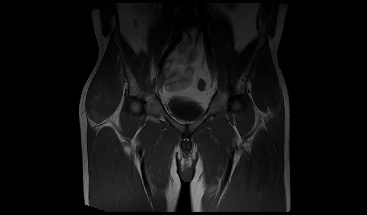 Soft tissue sarcoma MRI | Radiology article on Soft tissue sarcoma MRI