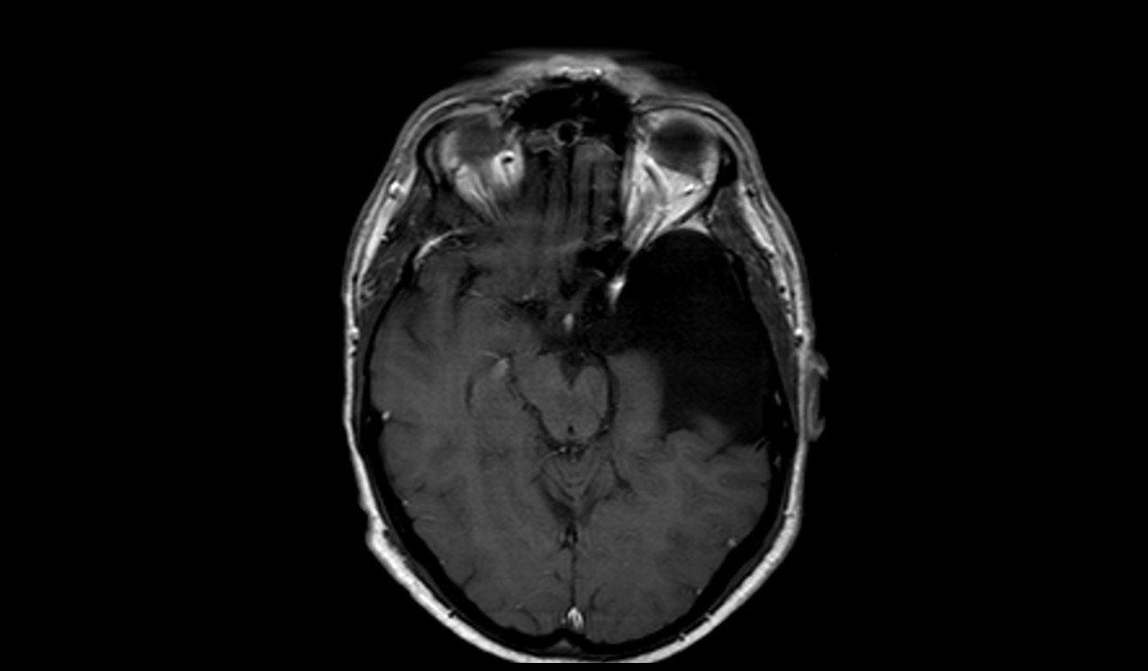 Arachnoid Cyst Mri Radiology Article On Arachnoid Cyst