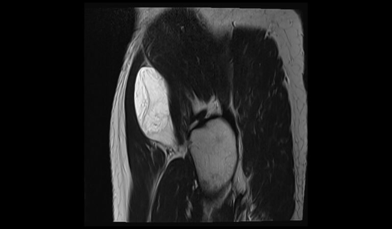 Soft tissue sarcoma MRI | Radiology article on Soft tissue sarcoma MRI