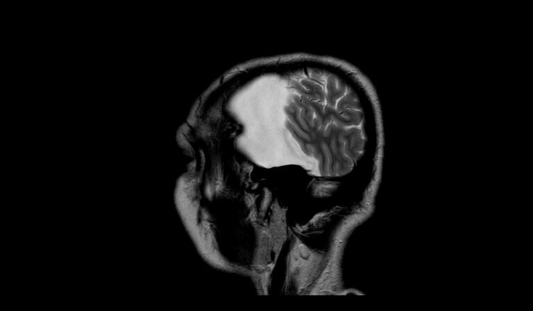 Arachnoid Cyst Mri Radiology Article On Arachnoid Cyst