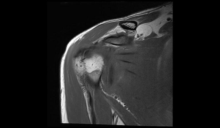 ALPSA Lesion MRI | Radiology Article on Anterior Labroligamentous ...