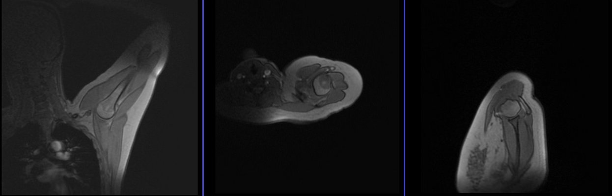 MRI Shoulder ABER view protocol and planning | ABER MRI positioning