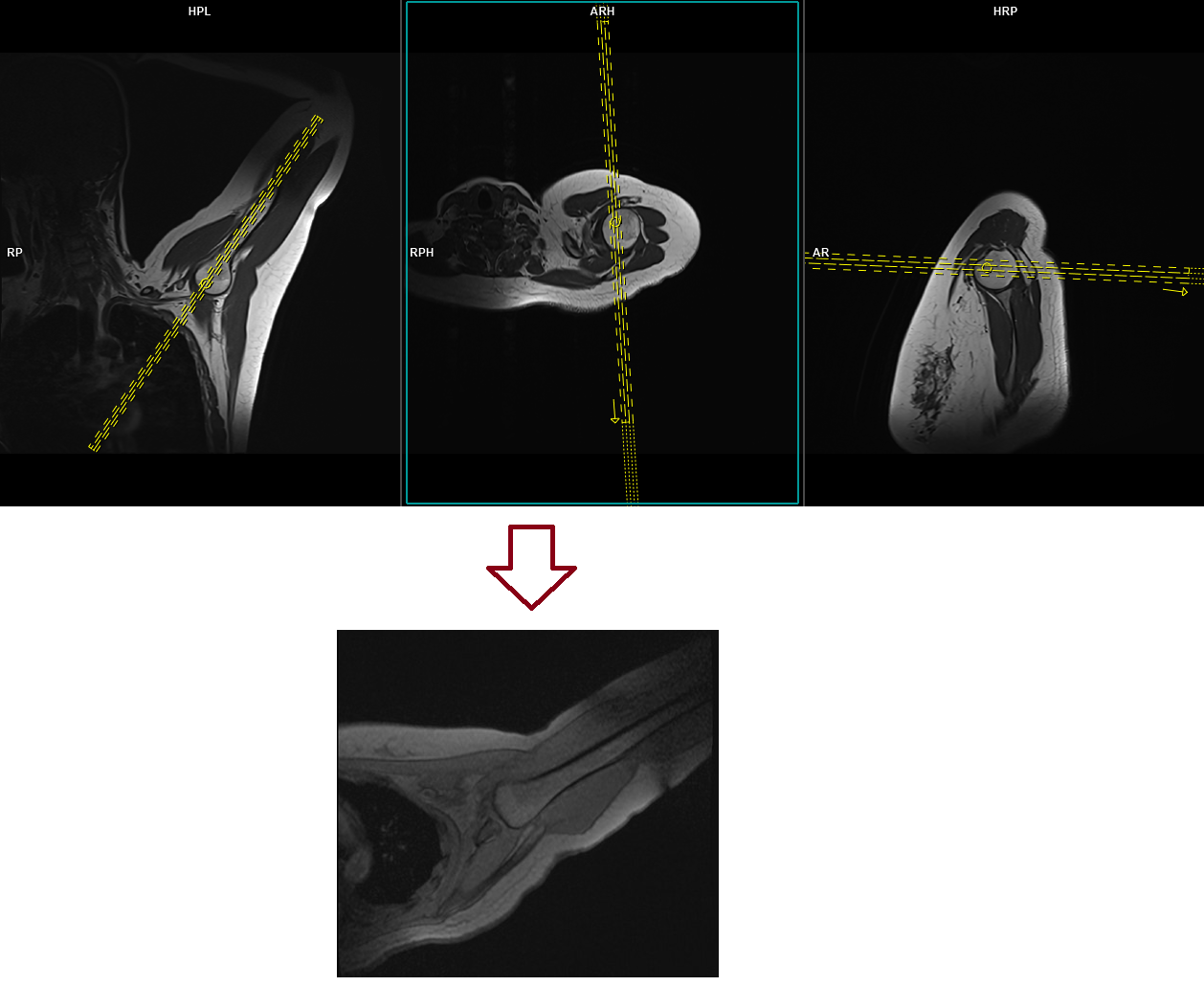 MRI Shoulder ABER view protocol and planning | ABER MRI positioning