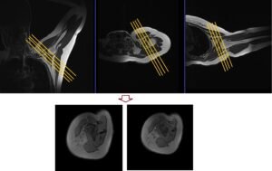 MRI Shoulder ABER view protocol and planning | ABER MRI positioning