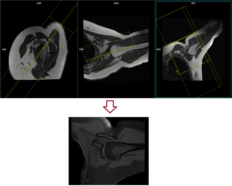 MRI Shoulder ABER view protocol and planning | ABER MRI positioning