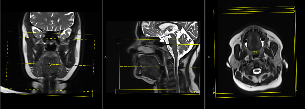 MRI Sialography Planning | MRI Sialography Protocols & Indications