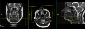 MRI Sialography Planning | MRI Sialography Protocols & Indications