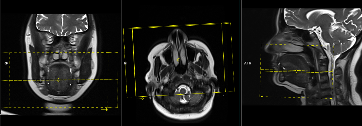 MRI Sialography Planning | MRI Sialography Protocols & Indications