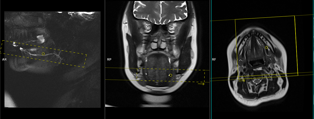 MRI Sialography Planning | MRI Sialography Protocols & Indications