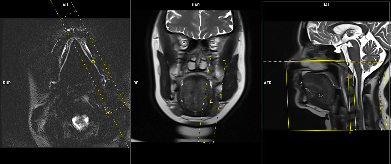 MRI Sialography Planning | MRI Sialography Protocols & Indications