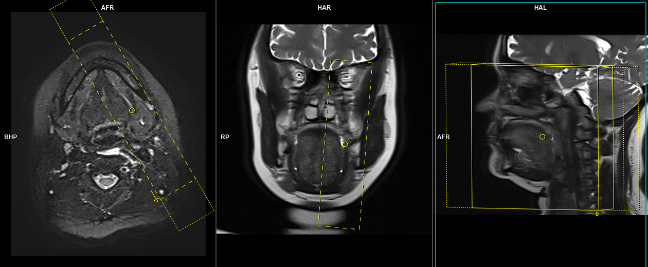MRI Sialography Planning | MRI Sialography Protocols & Indications