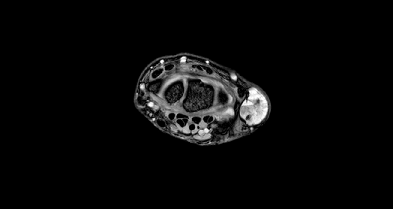 Wrist hemangioma MRI | Radiology article on wrist hemangioma