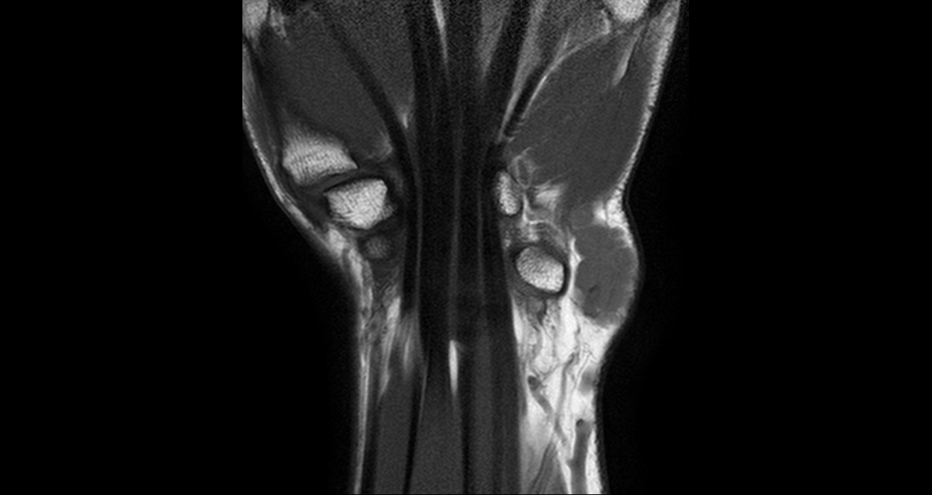 Wrist hemangioma MRI | Radiology article on wrist hemangioma