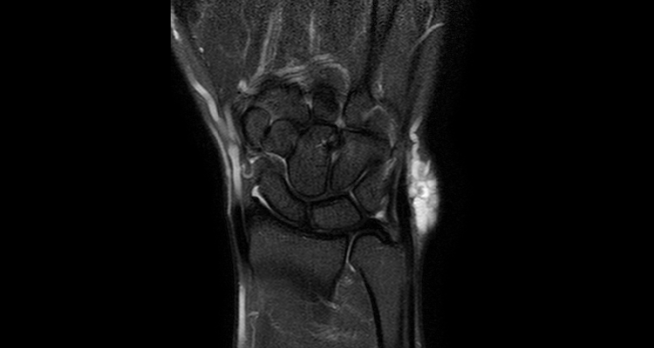 Wrist hemangioma MRI | Radiology article on wrist hemangioma