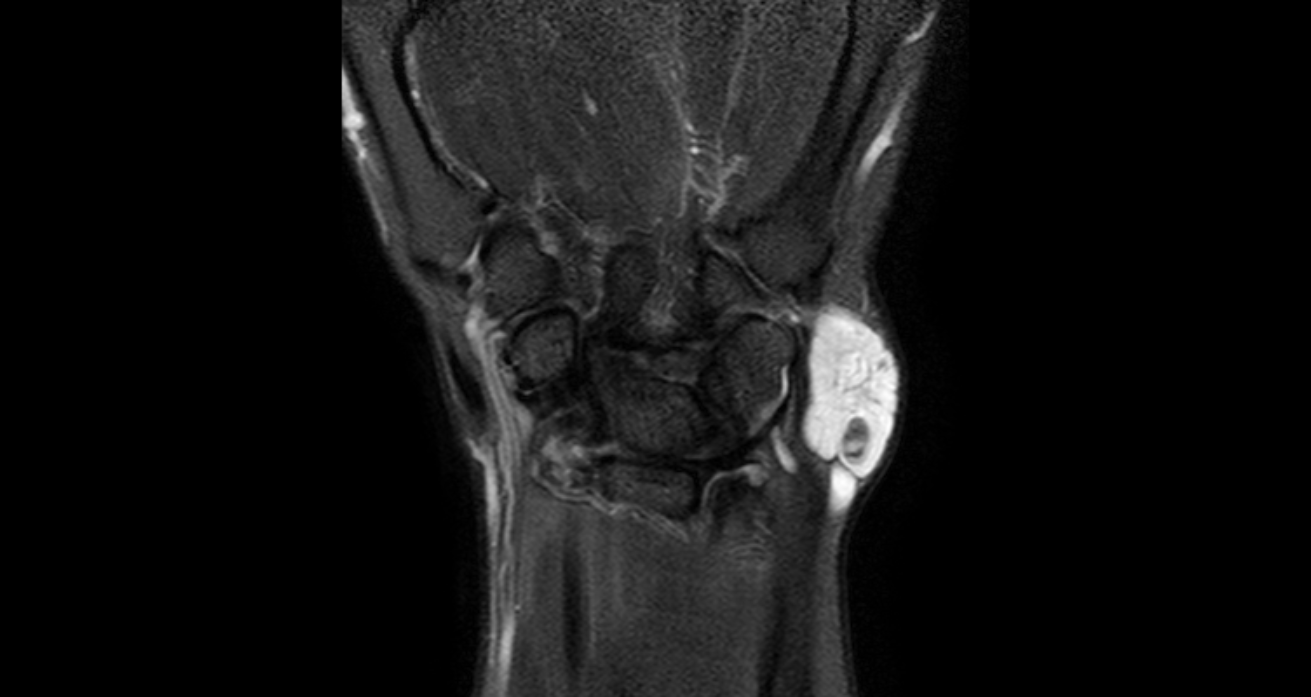 Wrist hemangioma MRI | Radiology article on wrist hemangioma