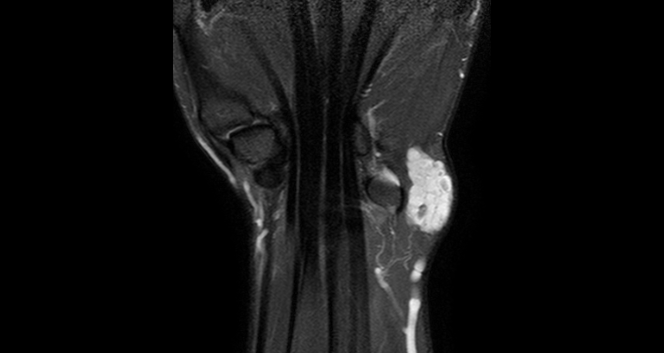 Wrist hemangioma MRI | Radiology article on wrist hemangioma