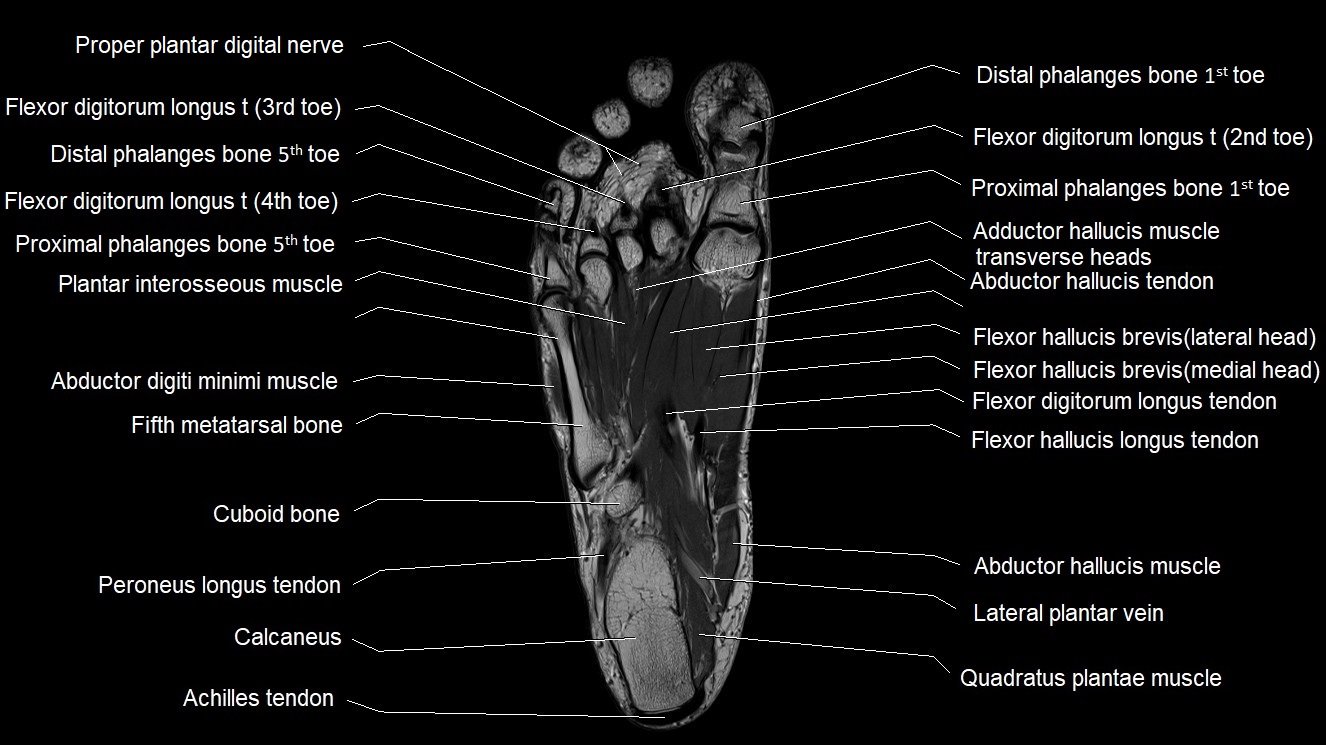 Plantar Foot Muscles Mri