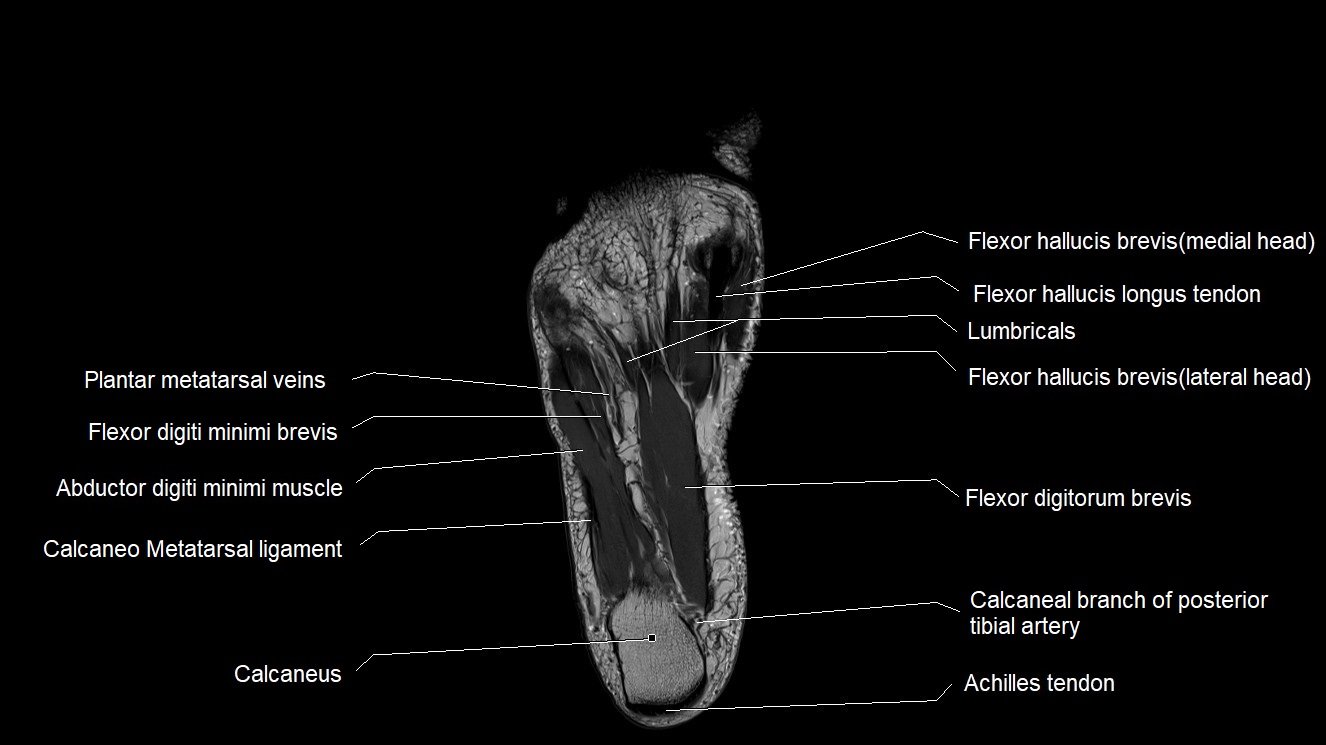 Plantar Foot Muscles Mri