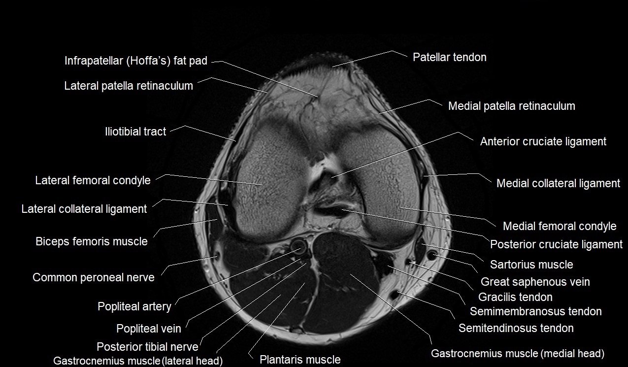 Cross Sectional Anatomy Mri The Knee (MRI): Atlas Of Anatomy In