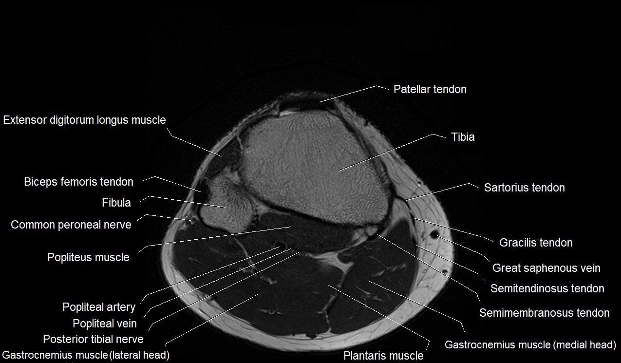 Mri Knee Axial Normal