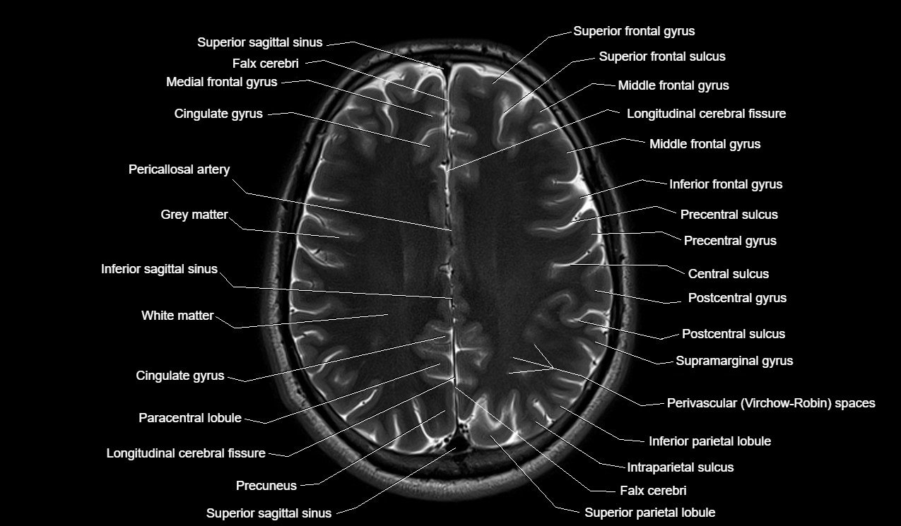 Axial Mri Brain Anatomy